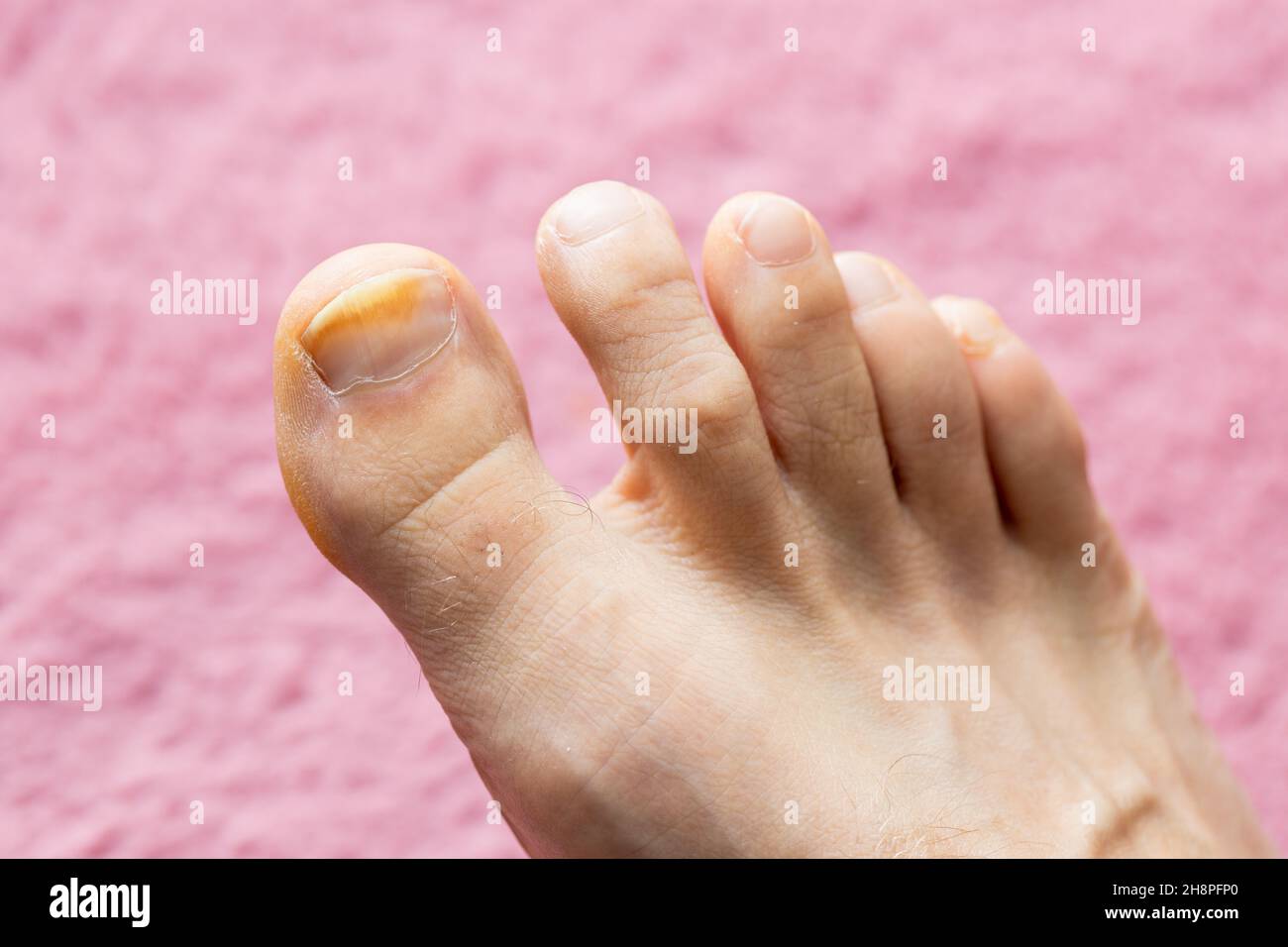 onychomycosis, the initial stage of ringworm. Big toe infected with ...