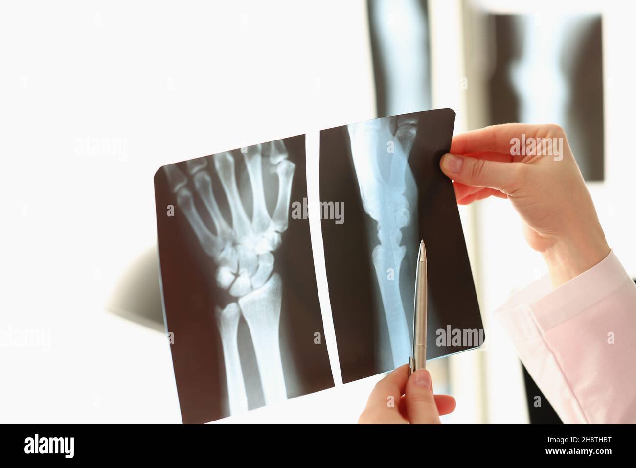 Female doctor looks at an x-ray of her hand Stock Photo - Alamy