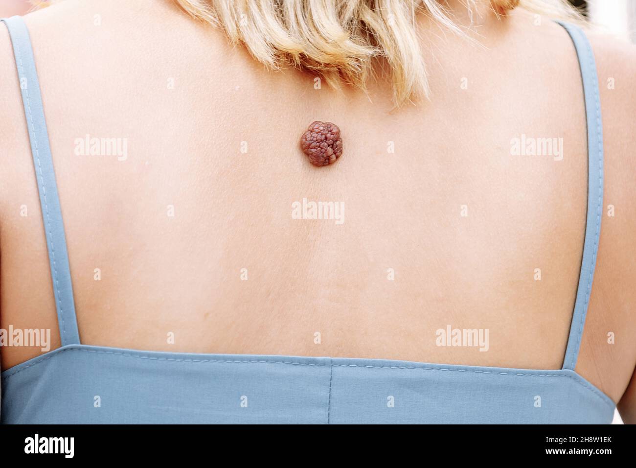 Wart. Mole. big wart on the skin. Skin diseases Malignant tumor ...