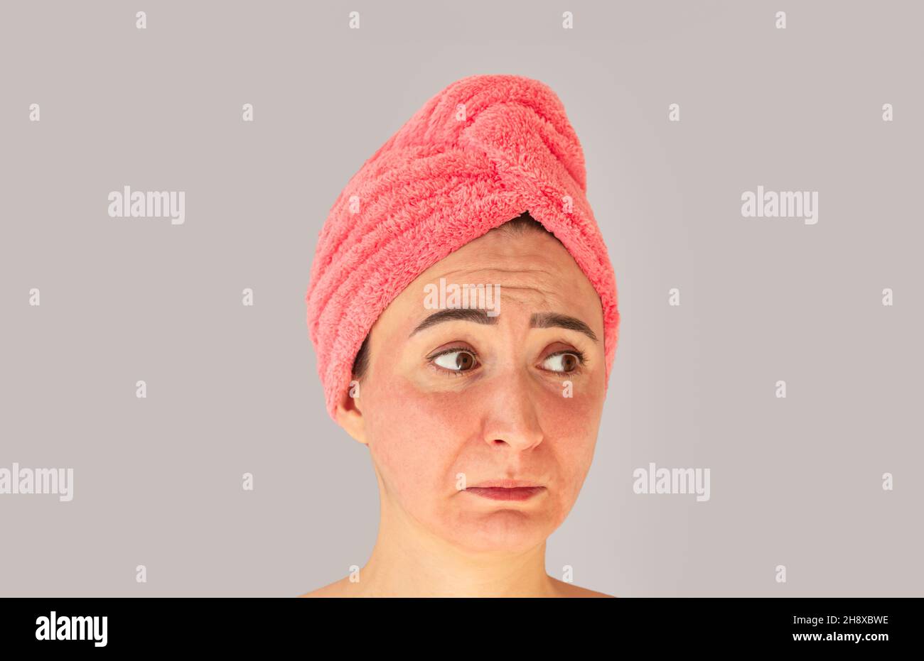 Sad face of young woman with skin irritation, redness, skin problems ...