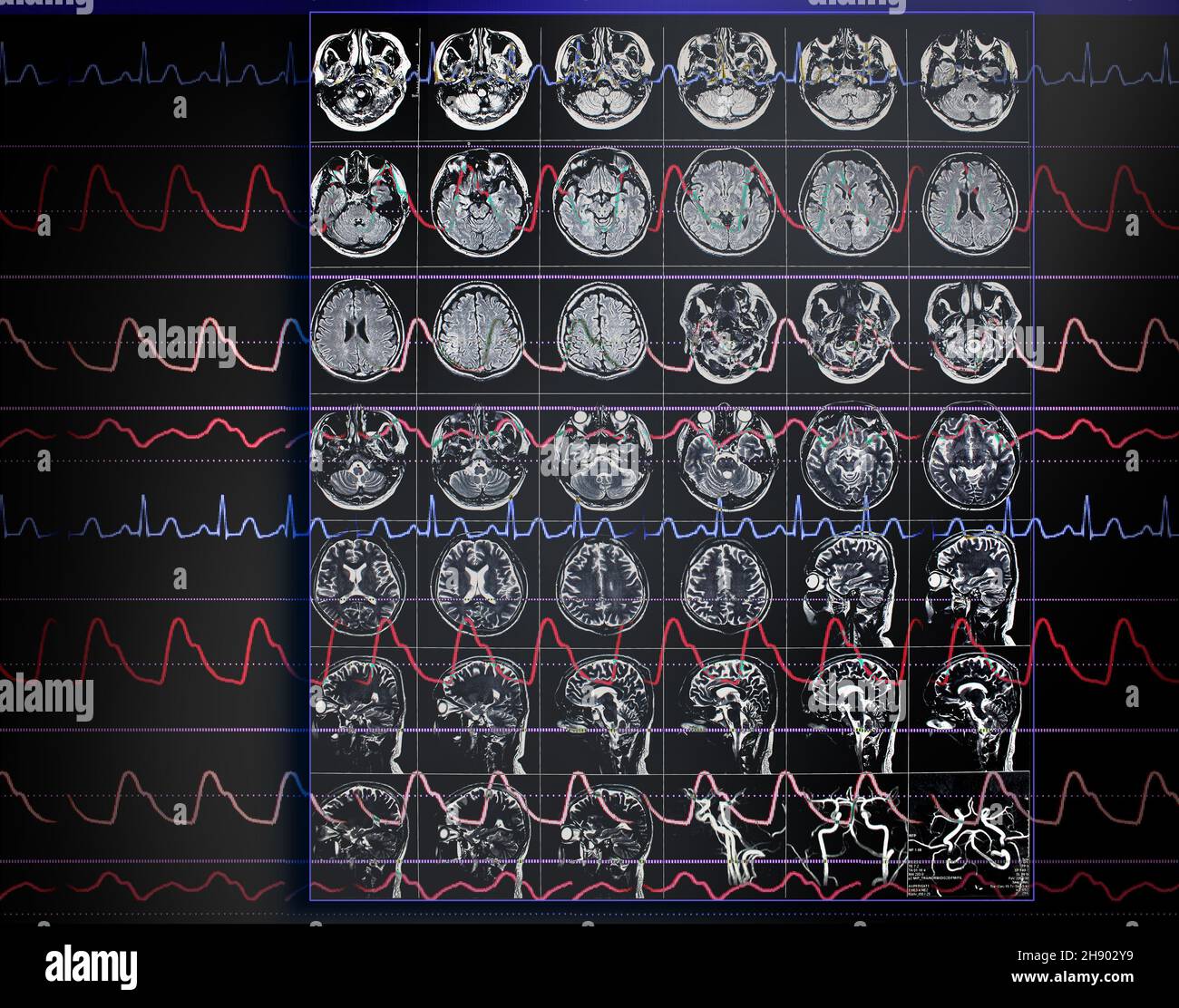 Monitoring of the patient's condition by the ECG tracing and CT imaging ...