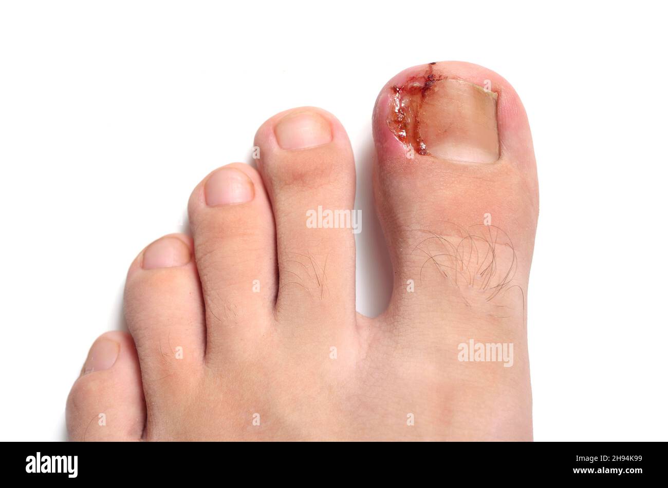 Nail figure, ingrown nail, purulence onychocryptosis Isolated on white ...