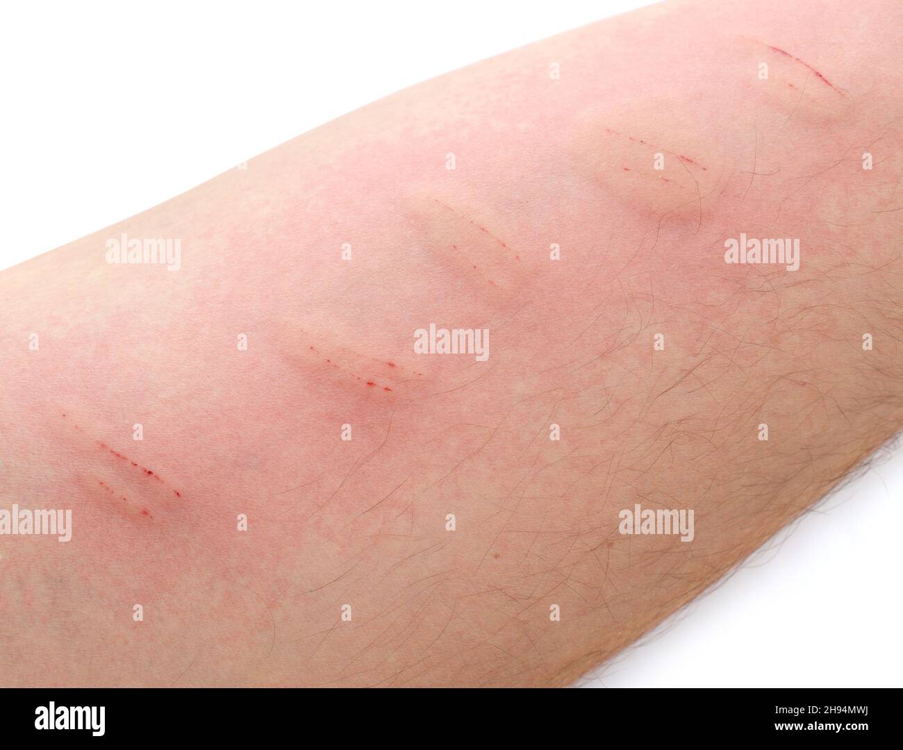 Allergy test at the arm hi-res stock photography and images - Alamy