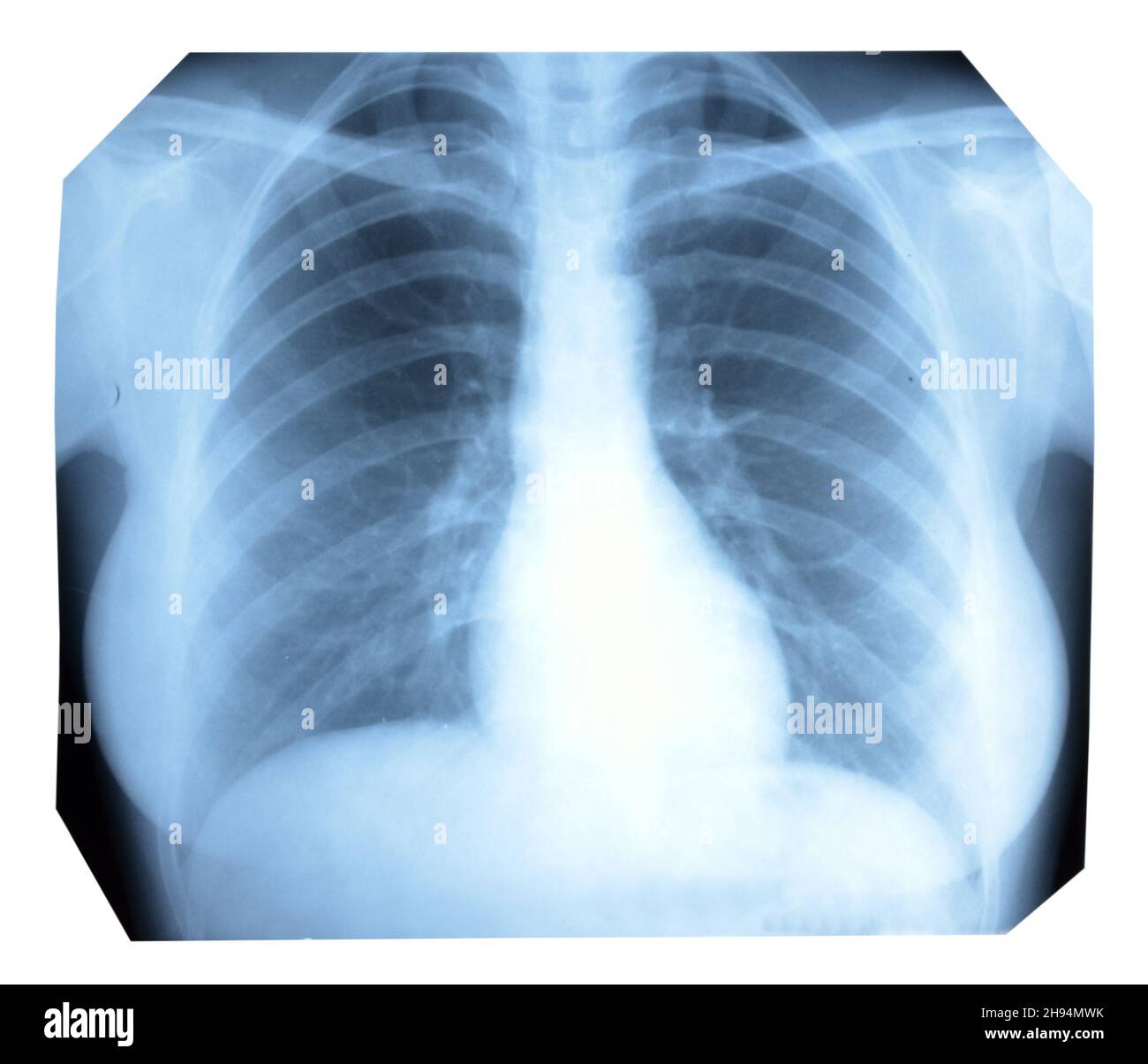 Photo X-ray of a healthy lung and heart Stock Photo - Alamy