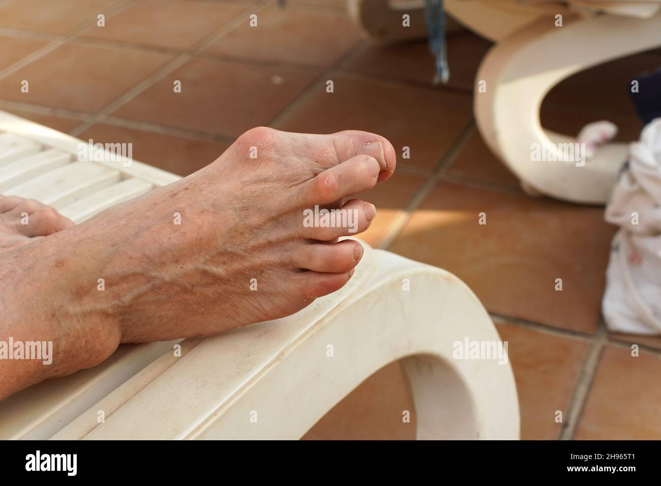 Severe bunion, also known as hallux valgus on foot of female senior ...