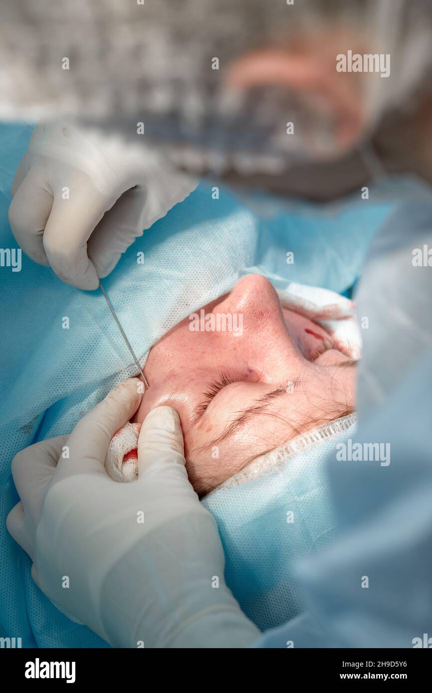 Close up of the face of a patient who is undergoing blepharoplasty. The ...