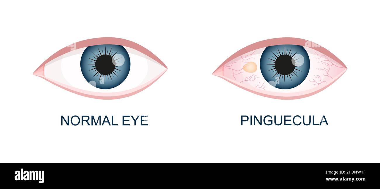 Pinguecula hi-res stock photography and images - Alamy