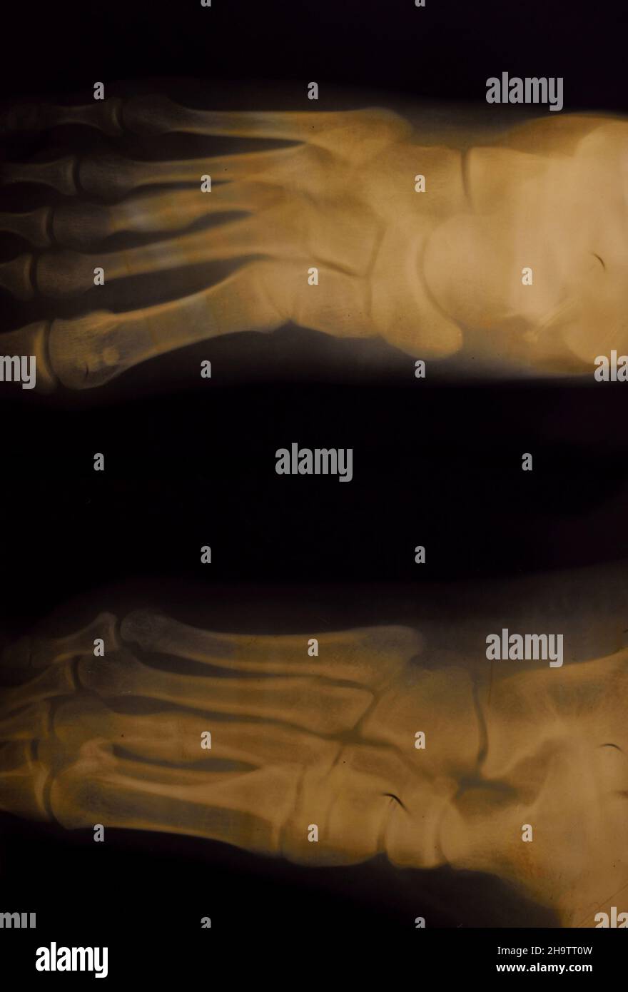 Callus finger hi-res stock photography and images - Alamy