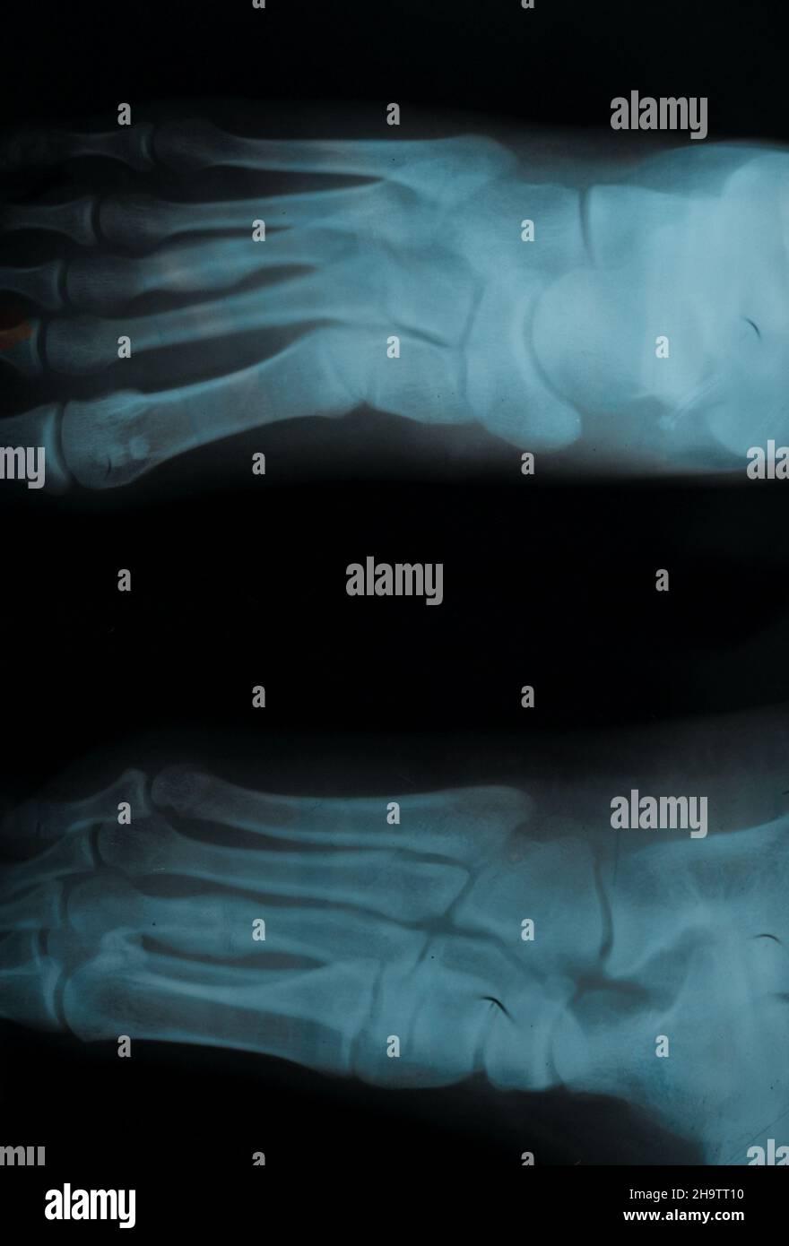 Fibrocartilage callus hi-res stock photography and images - Alamy