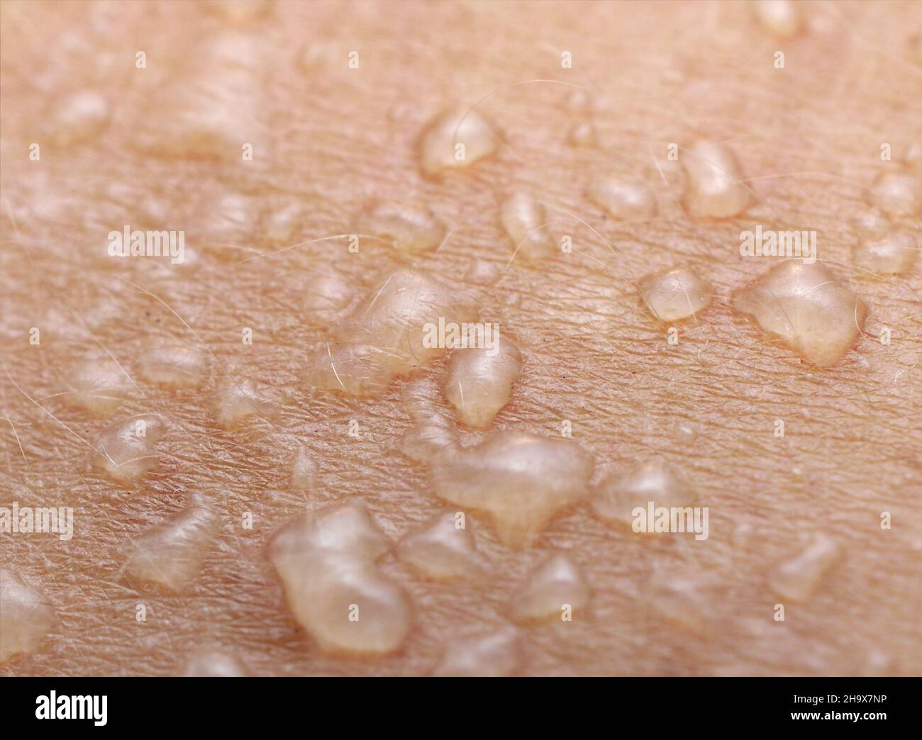 Eczema skin blisters hi-res stock photography and images - Alamy
