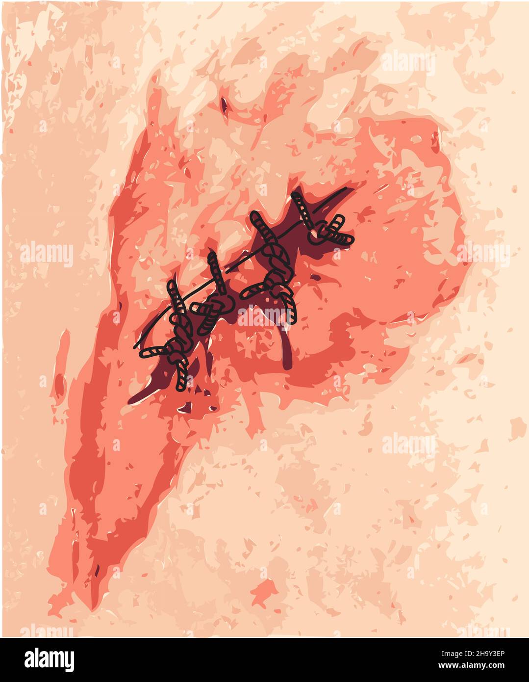 Post operative Stock Vector Images - Alamy