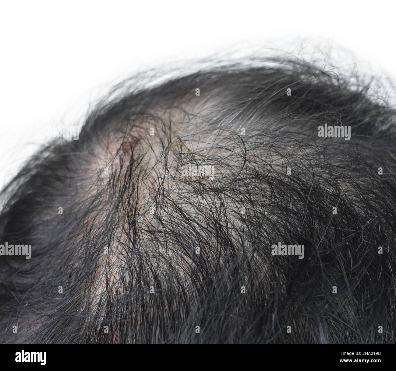 Thinning or sparse hair, male pattern hair loss in Southeast Asian ...