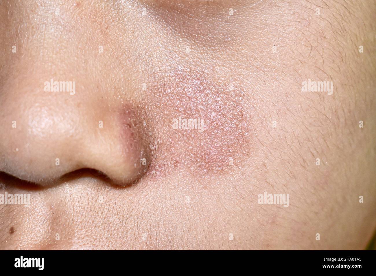 Tinea Faciei Afro Americana Tinea Corporis, Tinea Versicolor, And