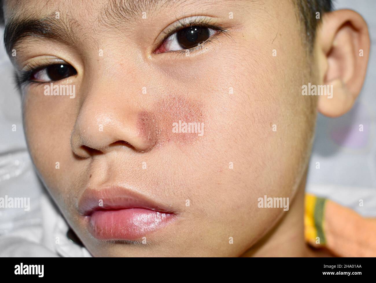 Dermatophyte hi-res stock photography and images - Alamy