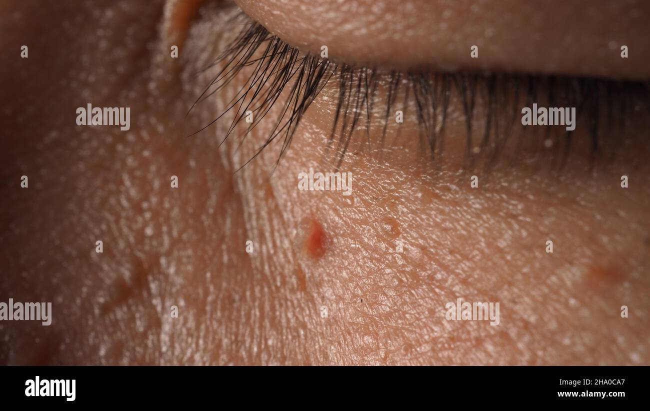 Verruca Vulgaris Face