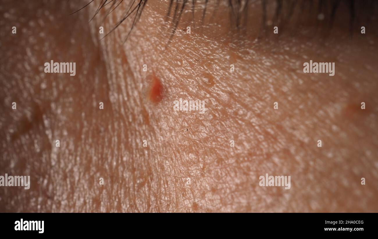 Wart on face. Macro shot of wart near eye. Papilloma on skin around eye ...