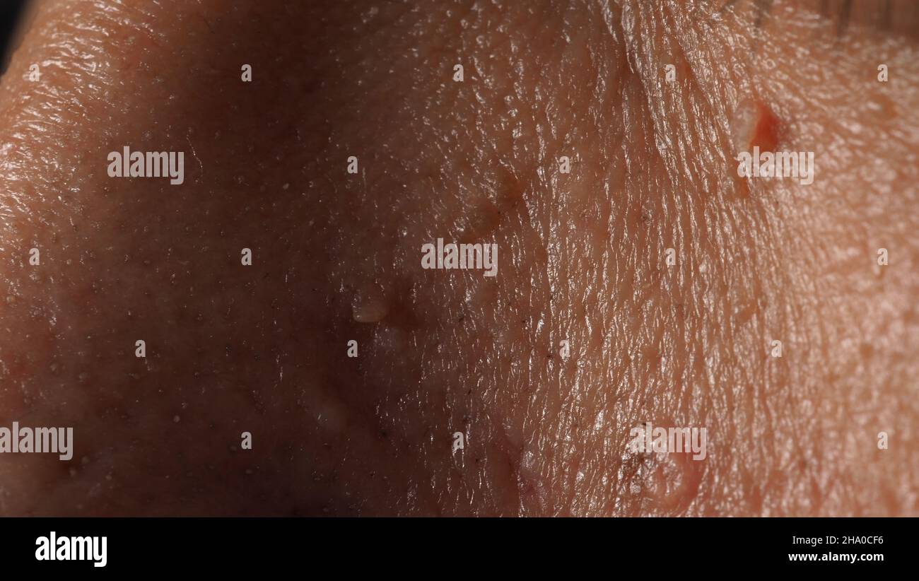 Wart on face. Macro shot of wart near eye. Papilloma on skin around eye ...