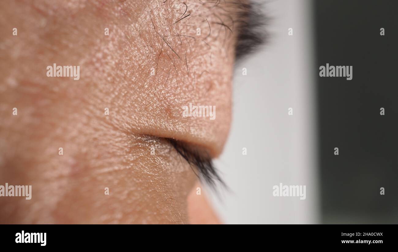 Verruca hi-res stock photography and images - Alamy