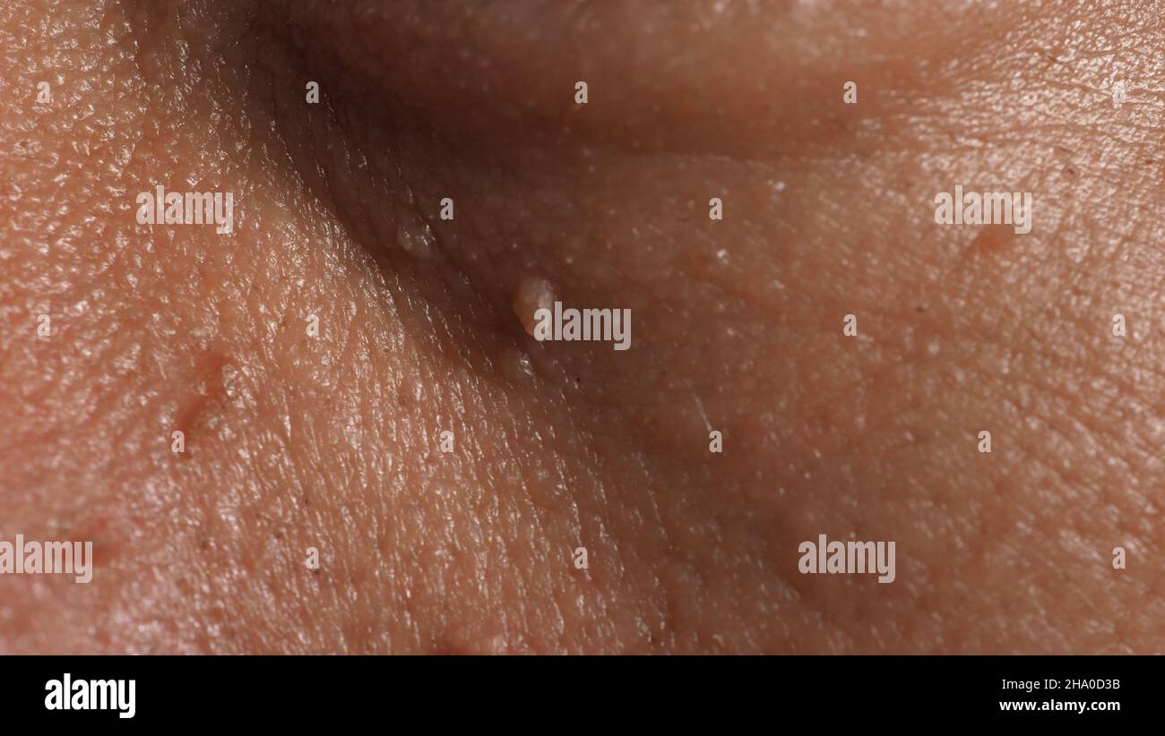 Wart on face. Macro shot of wart near eye. Papilloma on skin around eye ...
