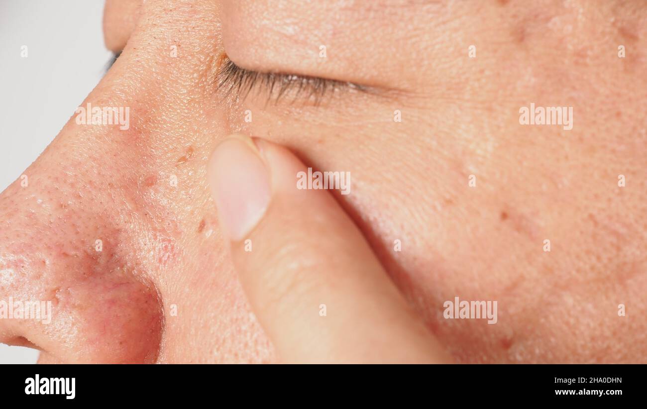 Wart on face. Macro shot of wart near eye. Papilloma on skin around eye ...