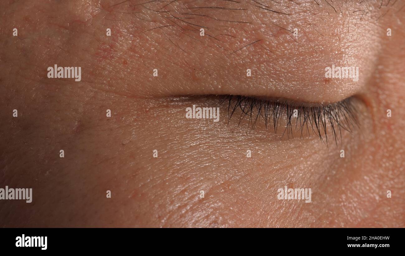 Wart on face. Macro shot of wart near eye. Papilloma on skin around eye ...