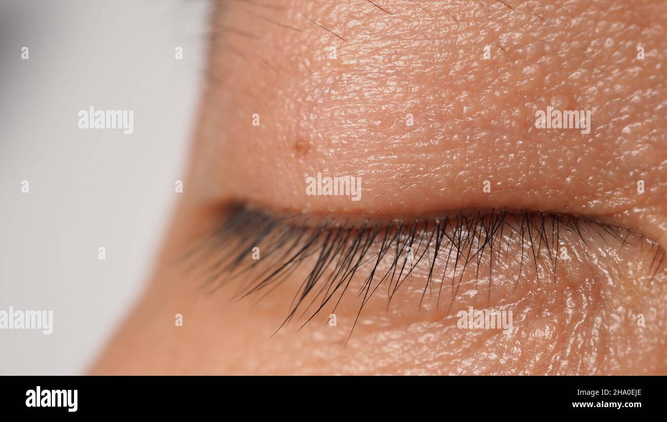 Wart on face. Macro shot of wart near eye. Papilloma on skin around eye ...