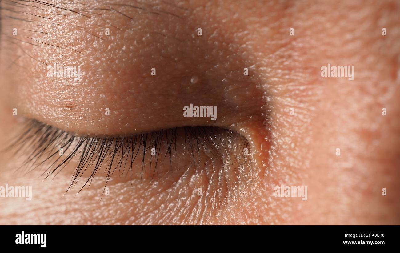 Wart on face. Macro shot of wart near eye. Papilloma on skin around eye ...