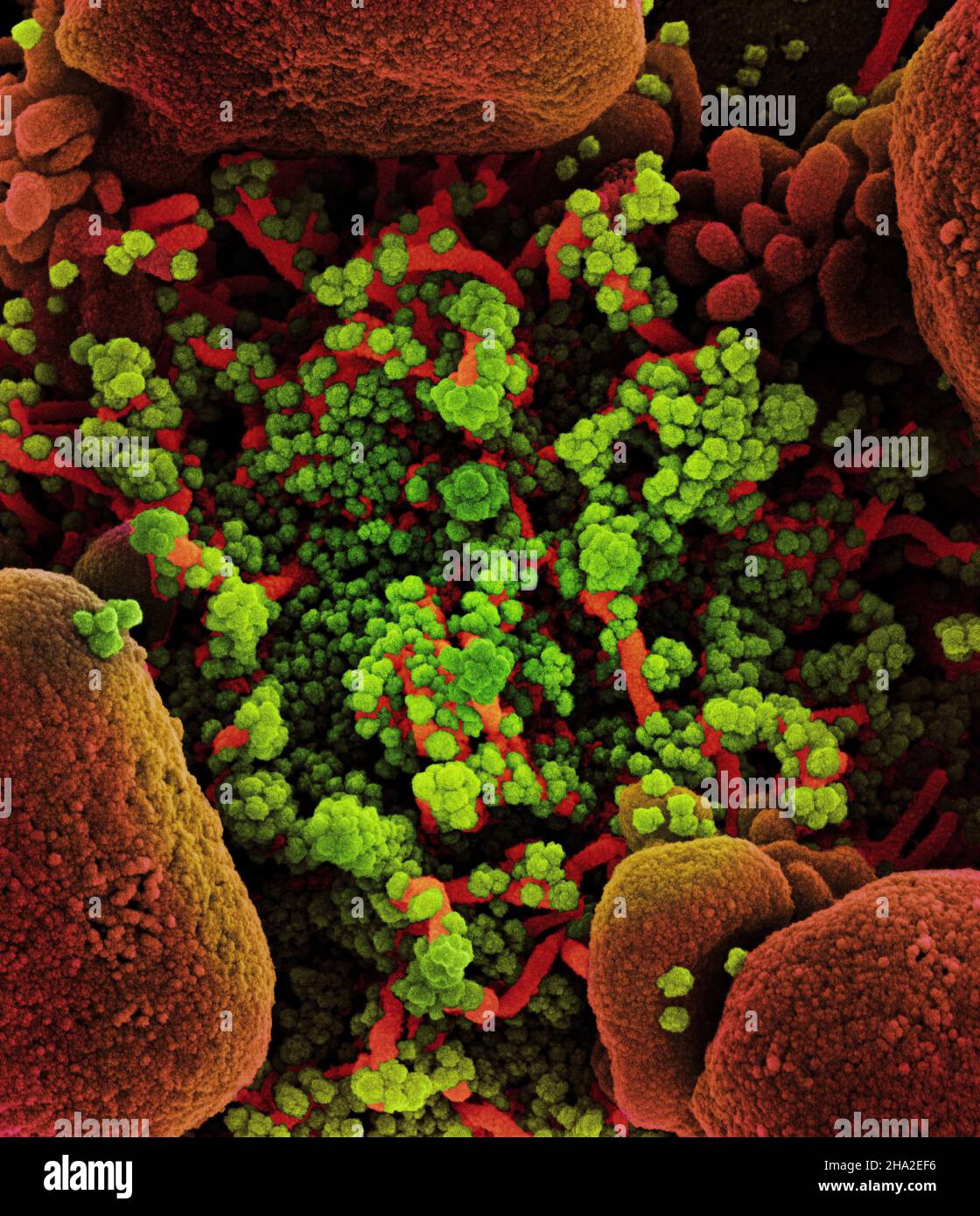Colorized scanning electron micrograph of an apoptotic cell (red ...