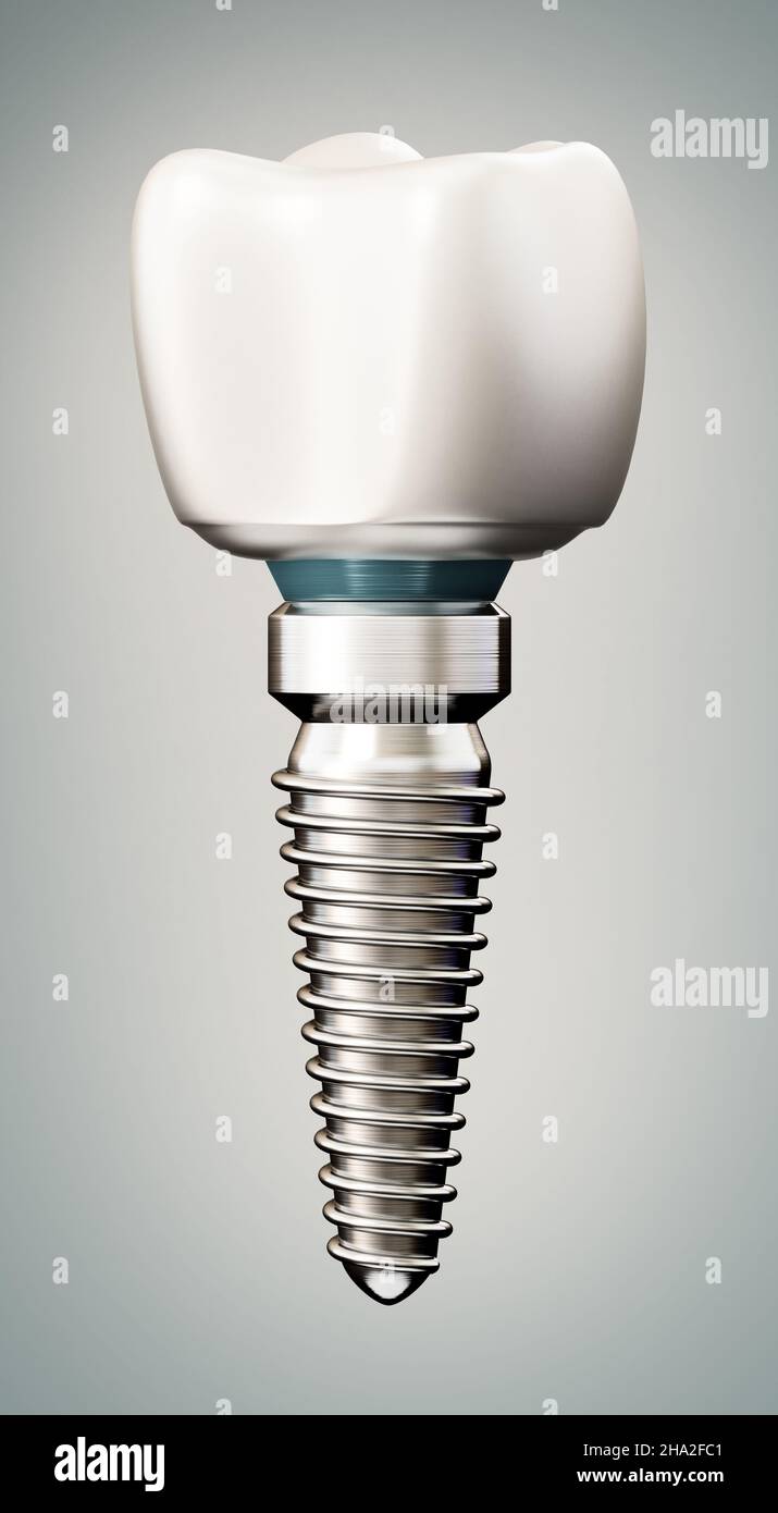 3D rendering of tooth implant. 3D illustration Stock Photo - Alamy