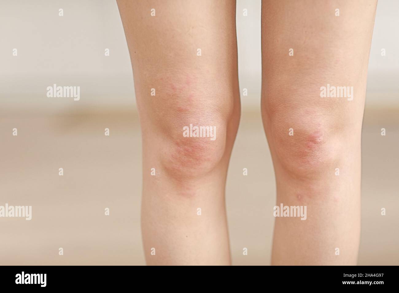 Skin Allergies Legs Skin Women Closeup Of Red Pustules On A Knee An