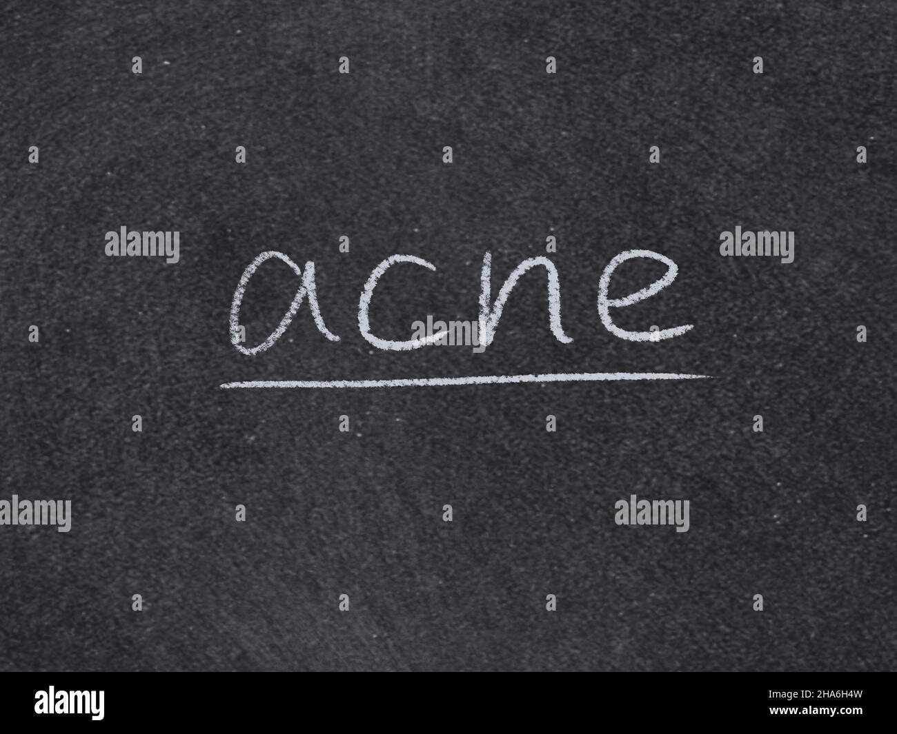 acne concept word on blackboard background Stock Photo - Alamy