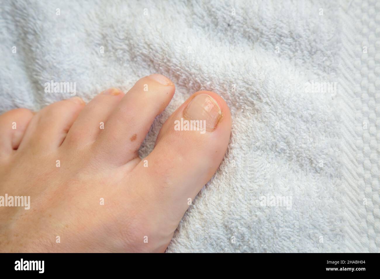 Details of man nails with fungal infection known as mycosis, natural ...