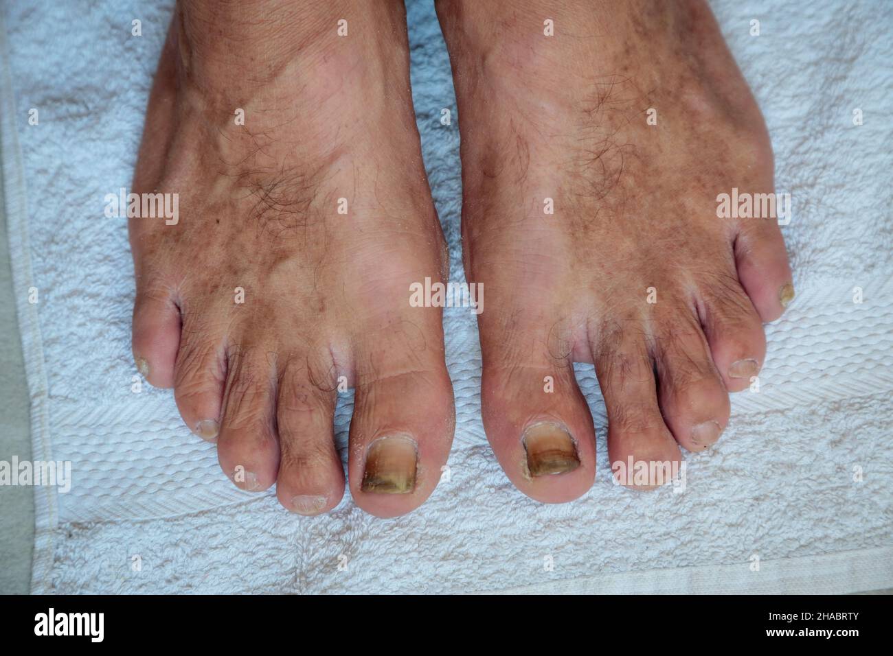 Details of man nails with fungal infection known as mycosis, natural ...