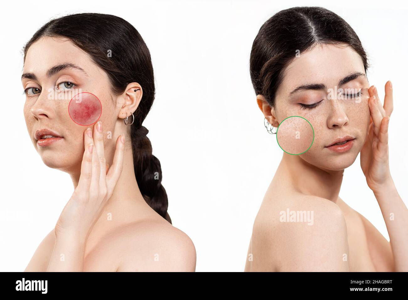 Concept of treatment of rosacea. Portrait of a young, beautiful woman ...
