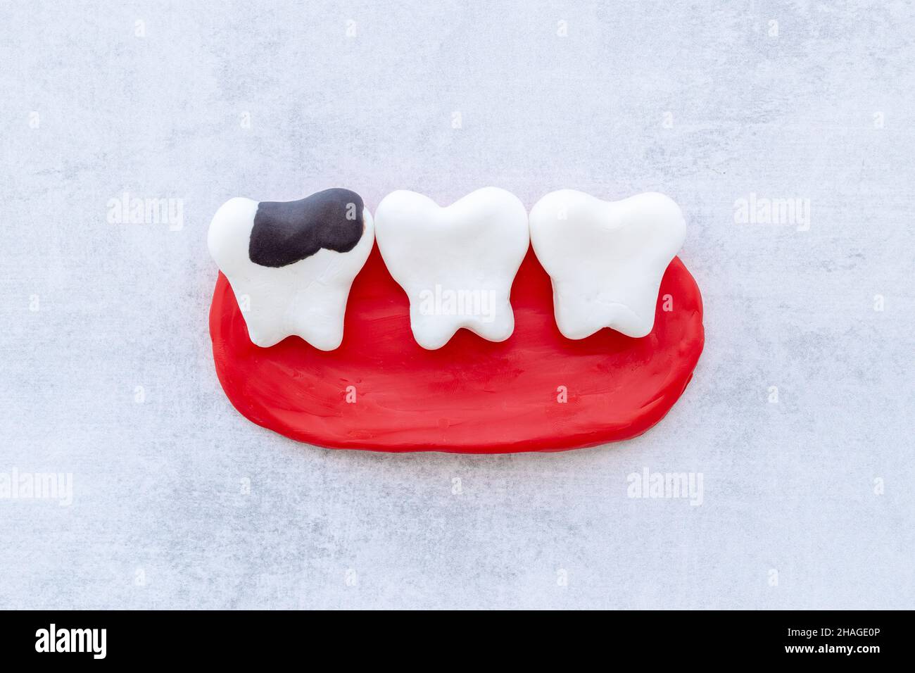 Oral health concept. Healthy and caries teeth models on gums Stock ...