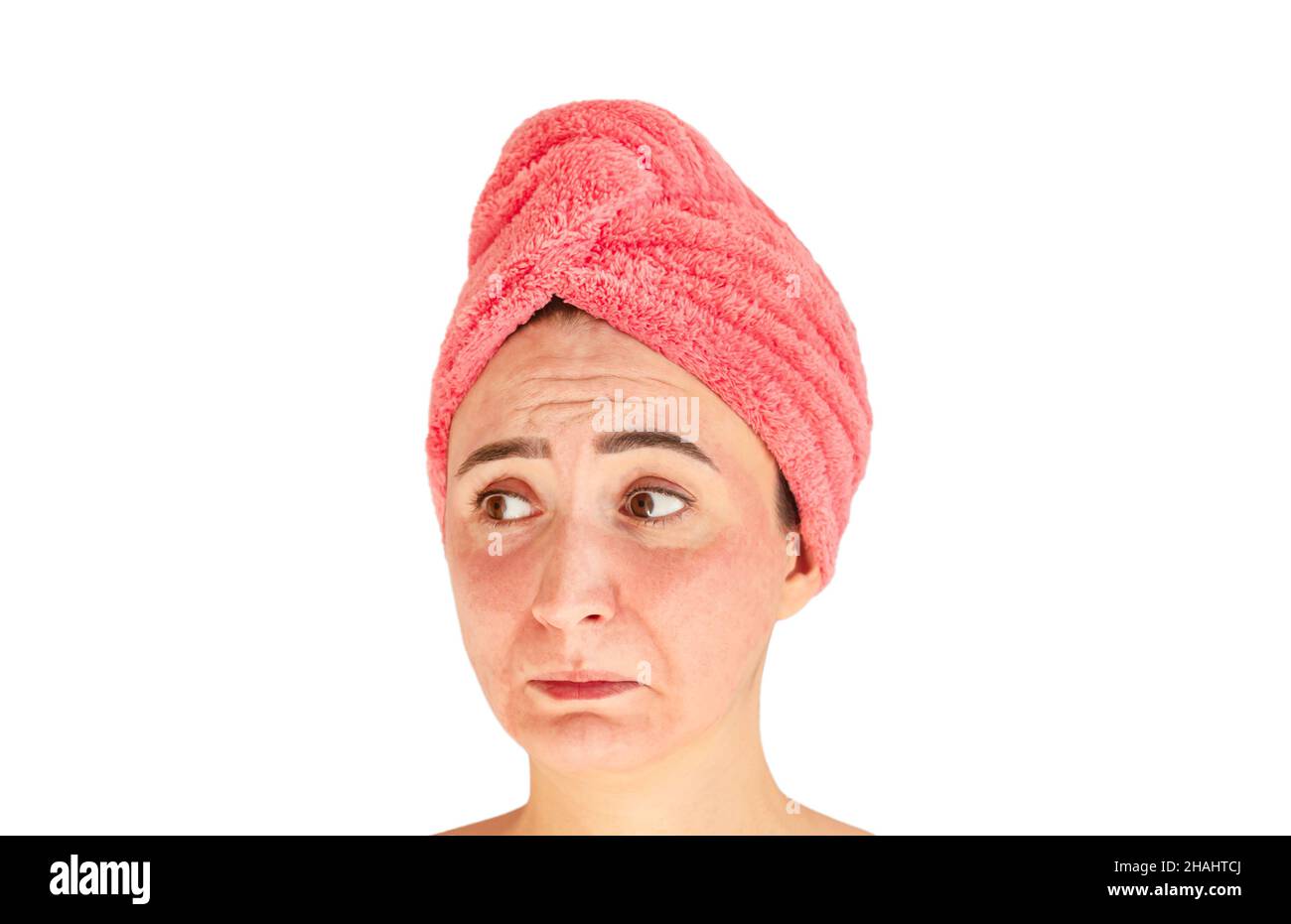 Sad face of young woman with skin irritation, redness, skin problems ...