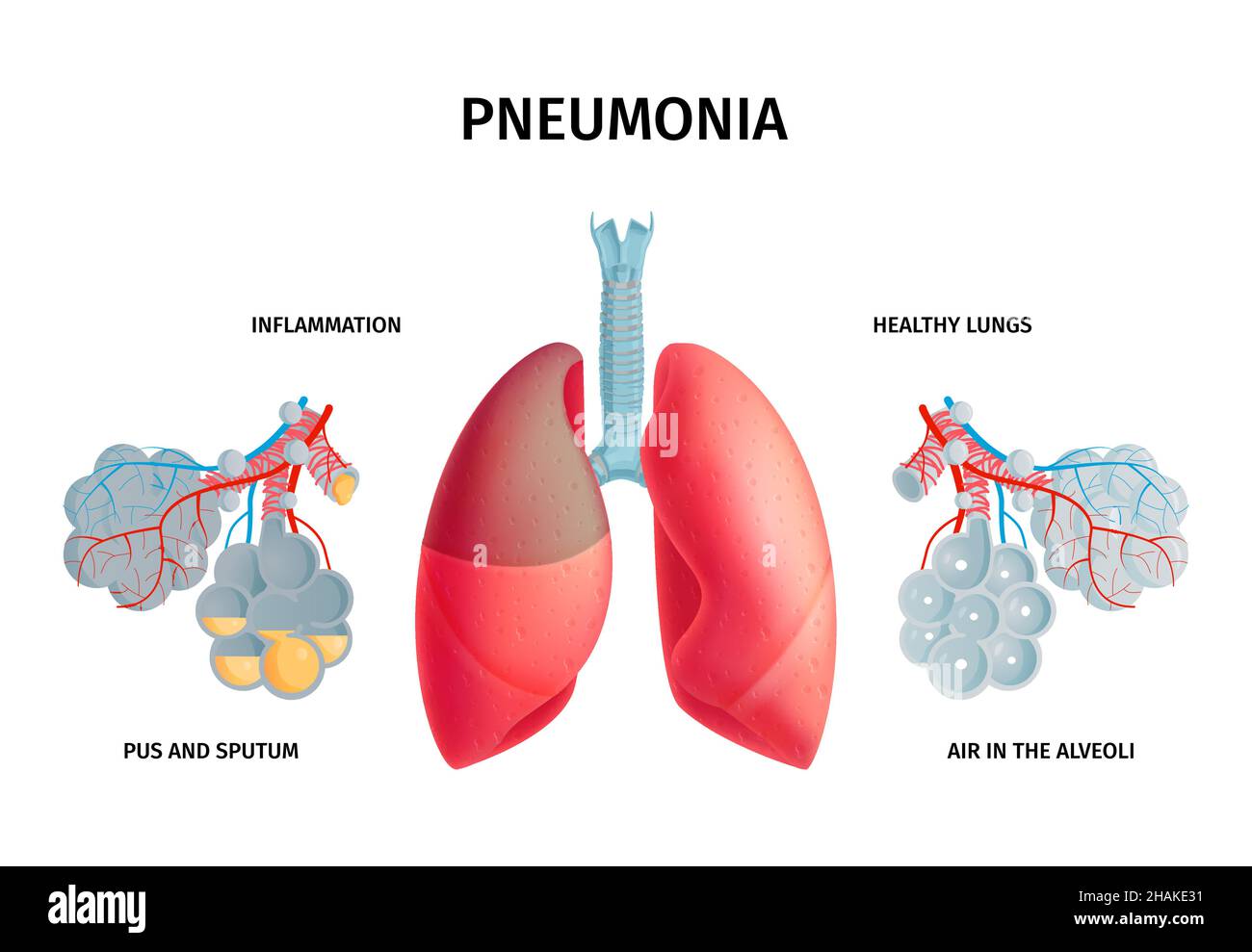 Human Lung Anatomy Infection Disease Inflammation Pneumonia Symptoms