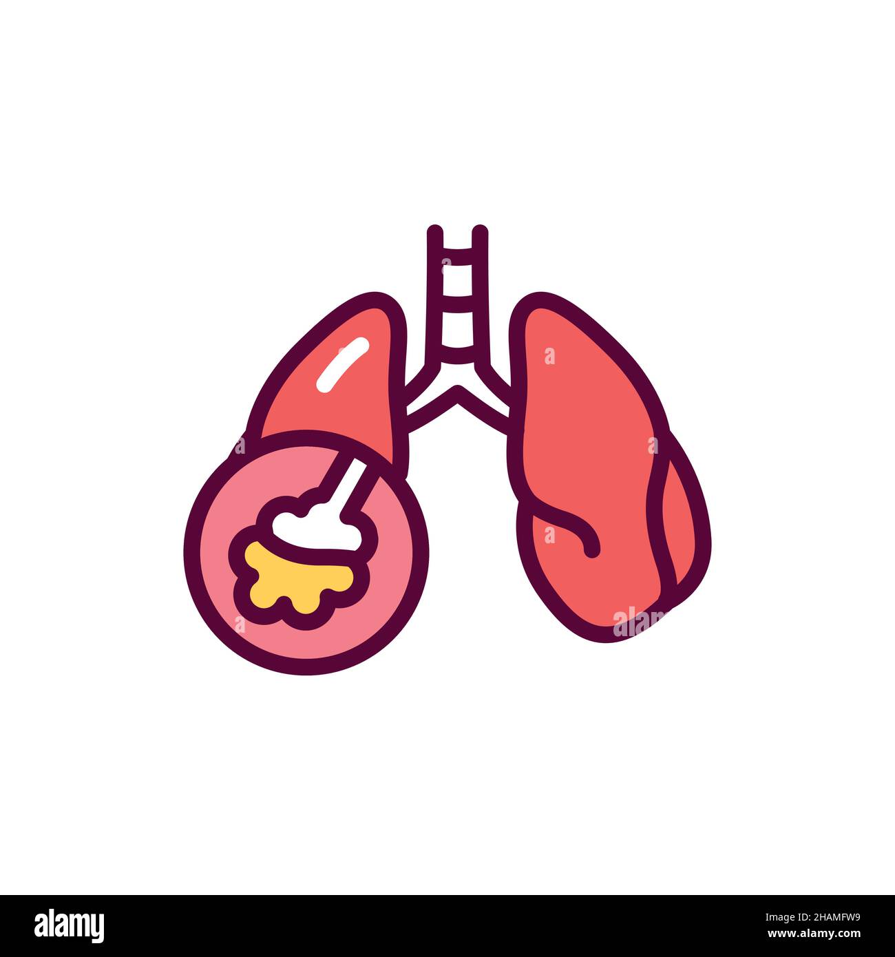 Pneumonia lung drawing hi-res stock photography and images - Alamy
