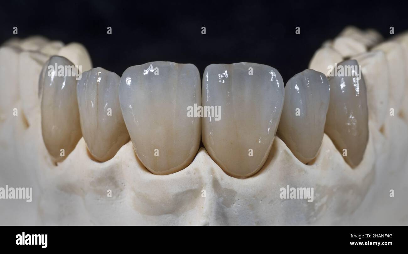 Closeup of a Ceramic crown on gypsum model on a shiny reflecting black ...