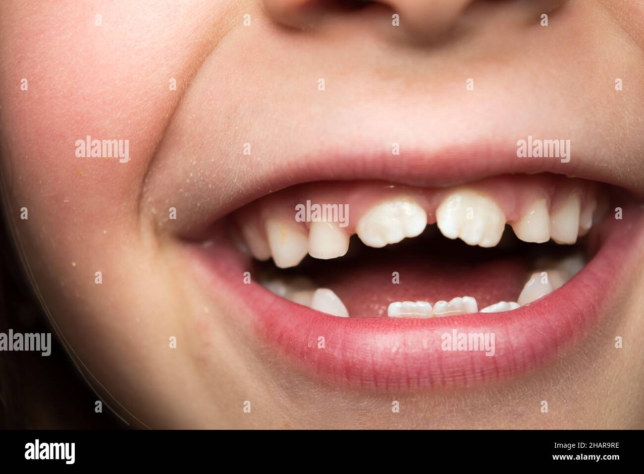 Closeup shot of a smiling child's face with new growing teeth Stock ...