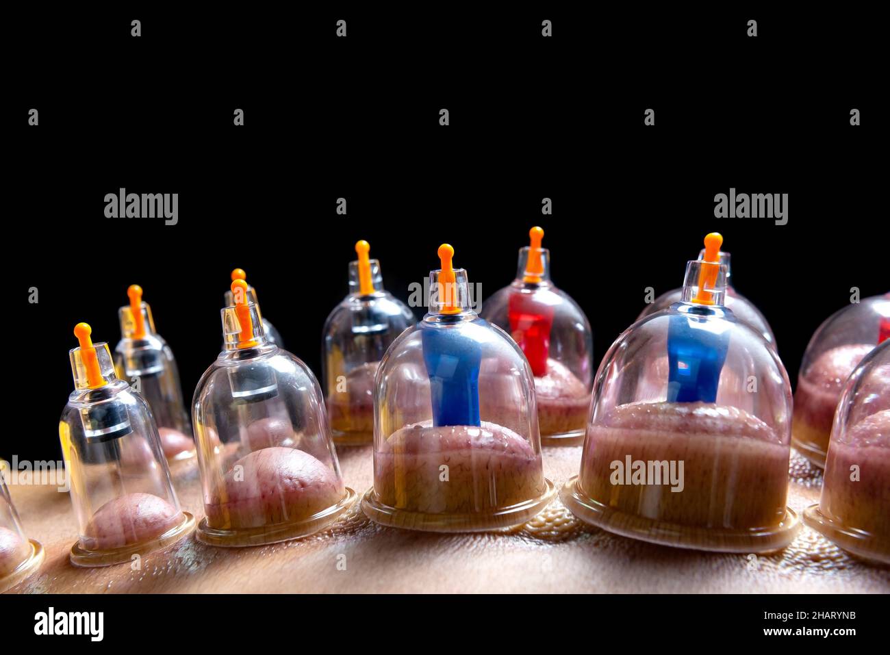 Cupping therapy man hi-res stock photography and images - Alamy