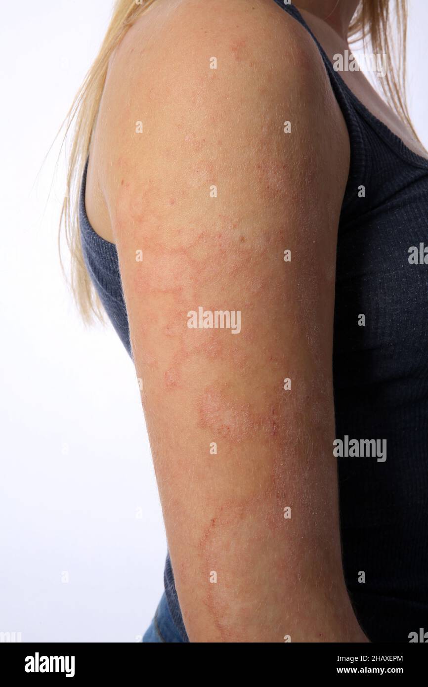 Symptoms of a pulp on the skin of a young woman Stock Photo - Alamy