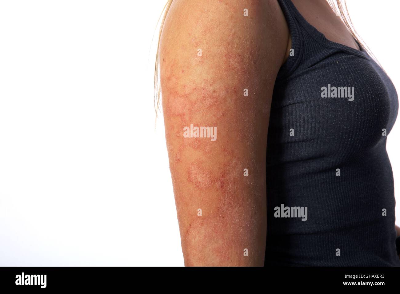 Symptoms of a pulp on the skin of a young woman Stock Photo - Alamy