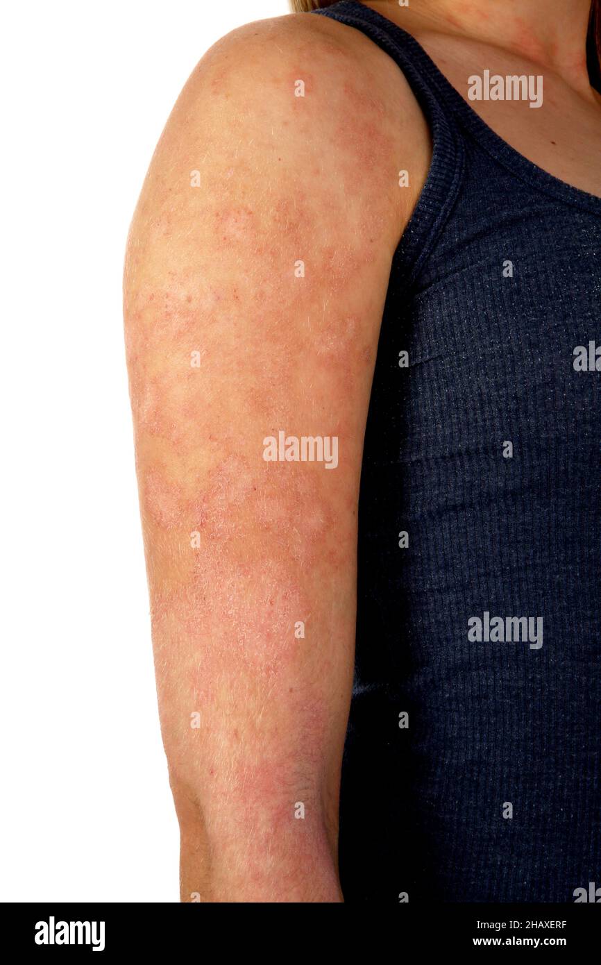 Symptoms of a pulp on the skin of a young woman Stock Photo - Alamy