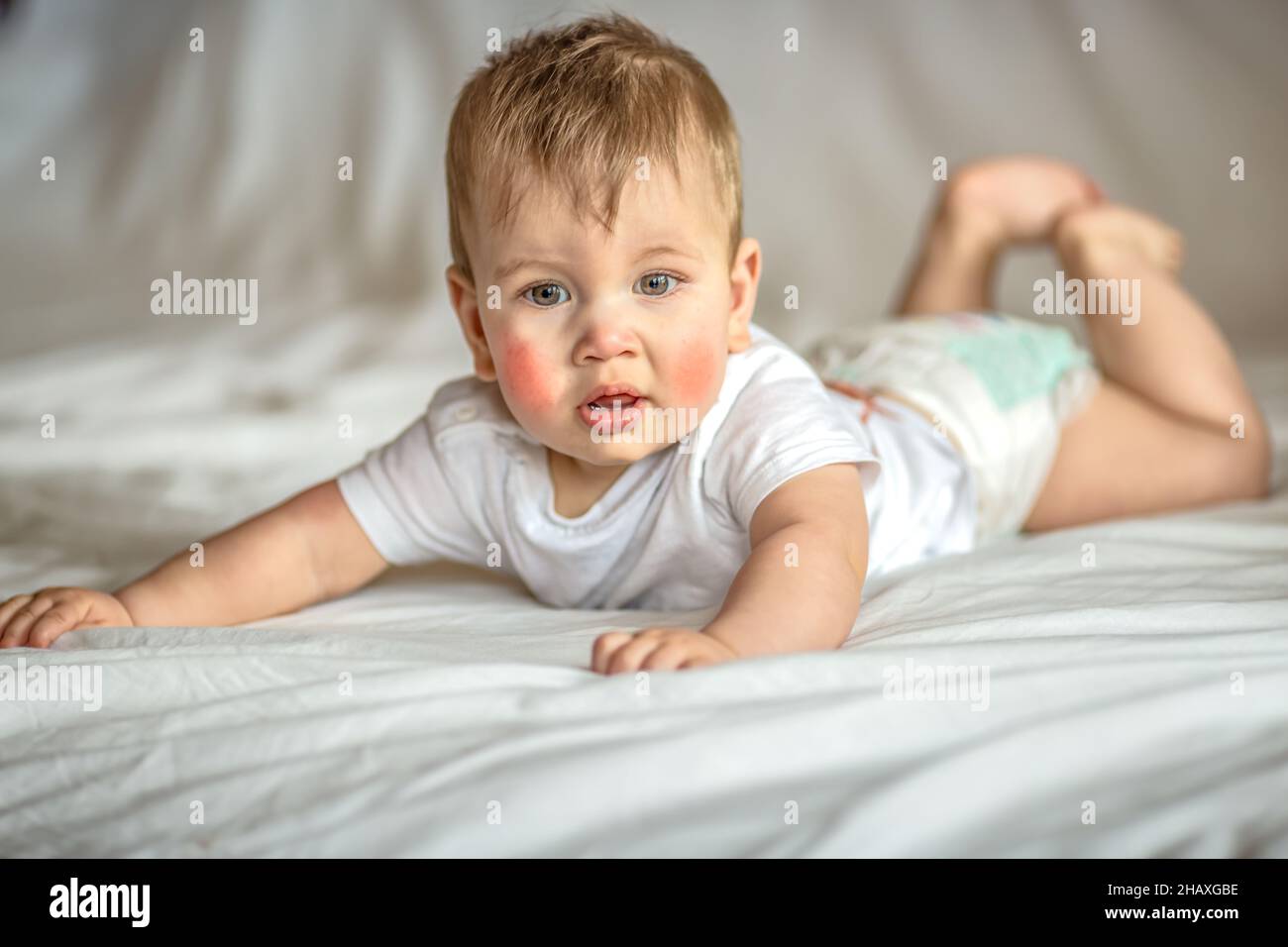 Atopic dermatitis eczema in baby.Condition that causes the skin to ...