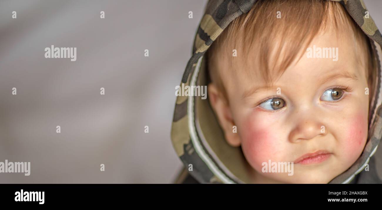 Atopic dermatitis eczema in baby.Condition that causes the skin to ...