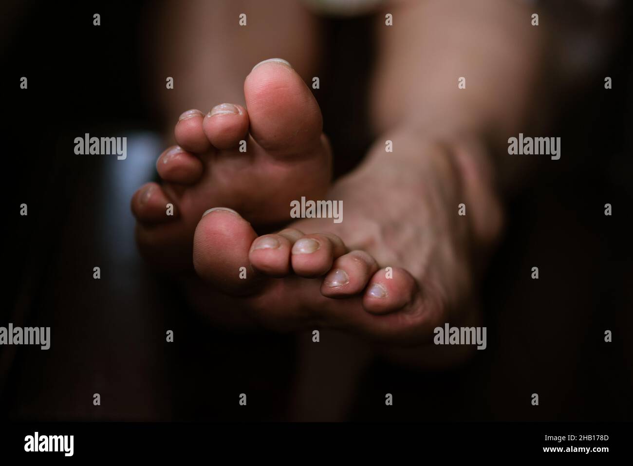 Woman' legs with uneven toe. Close-ups of both feet with selective ...