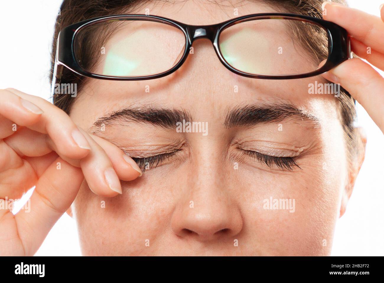 Ophthalmology. Close-up of woman's face scratches her painful eyes ...