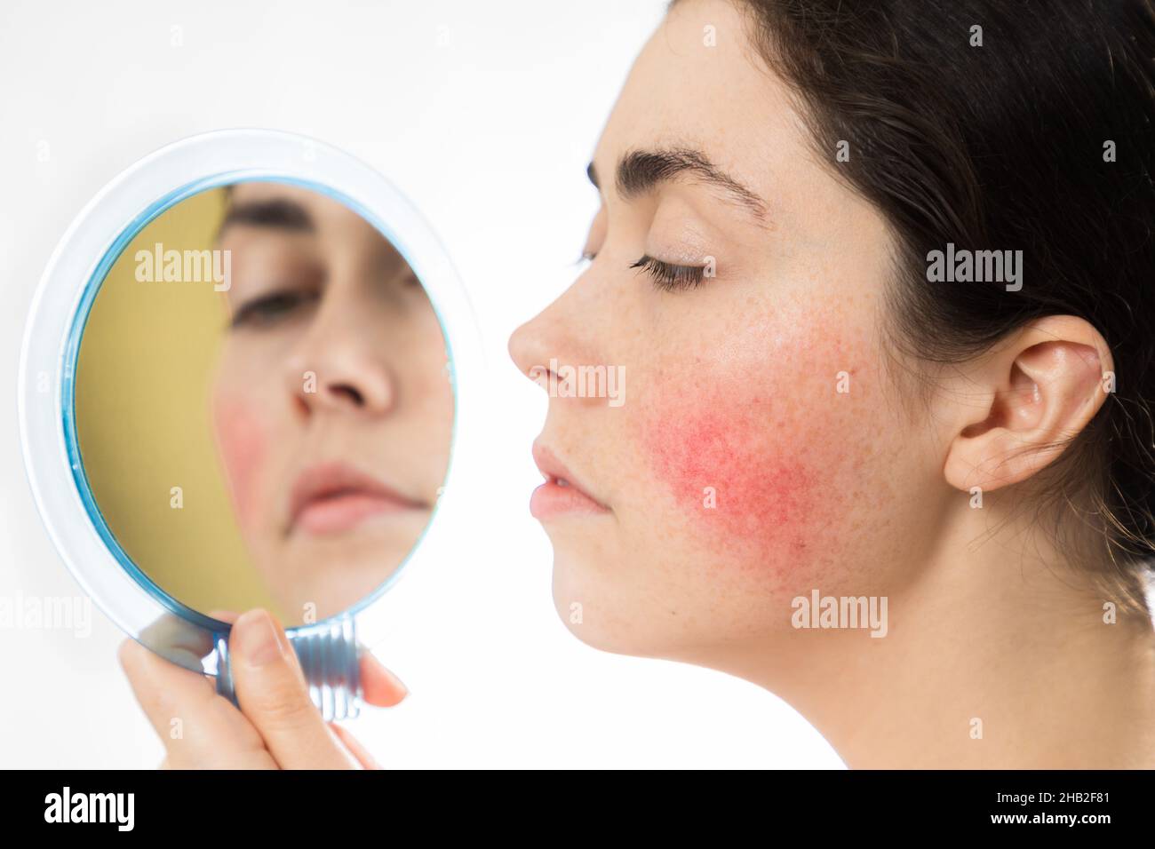 Beautiful young woman with rosacea on her cheek looking at the mirror ...