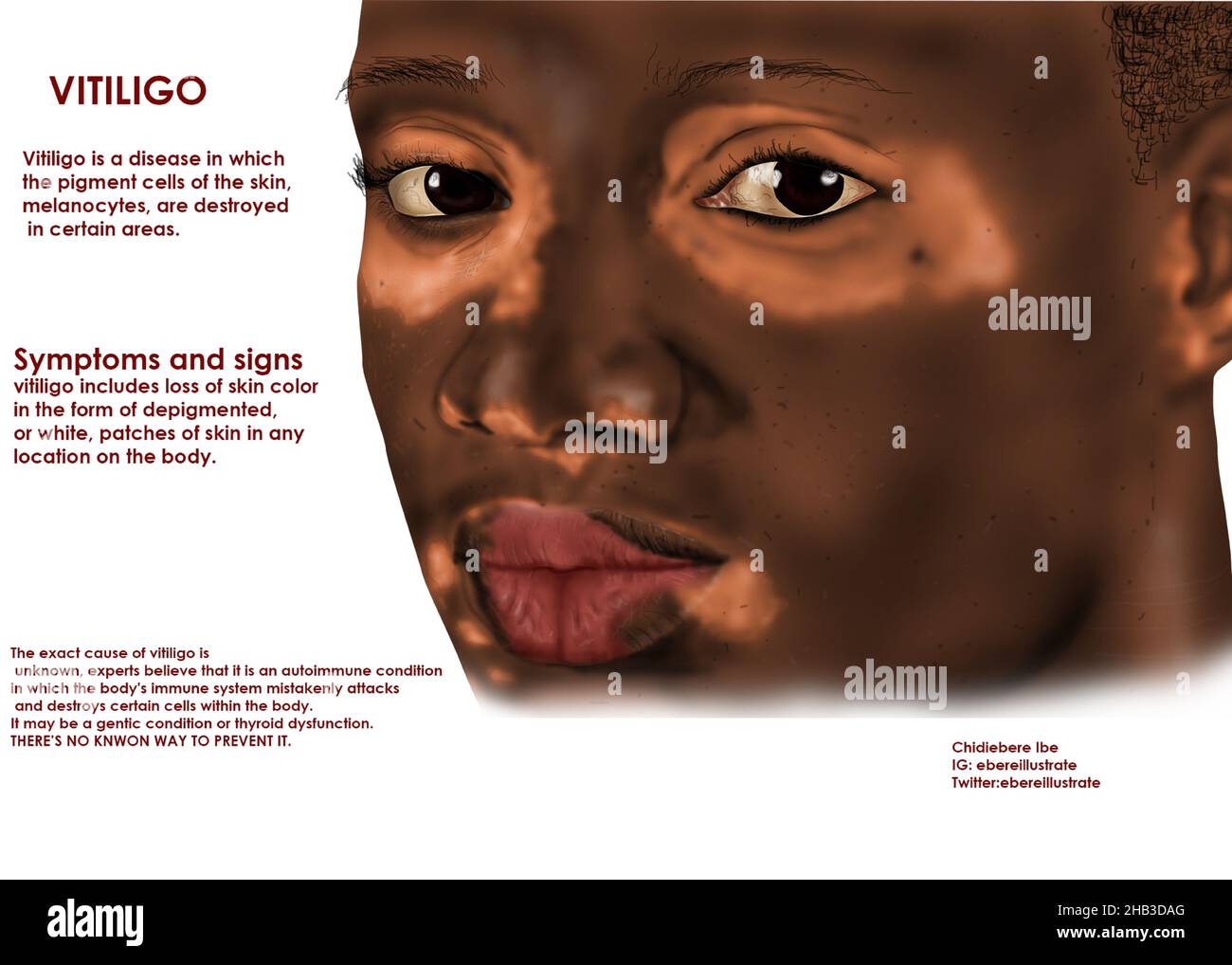 Vitiligo skin condition hi-res stock photography and images - Alamy